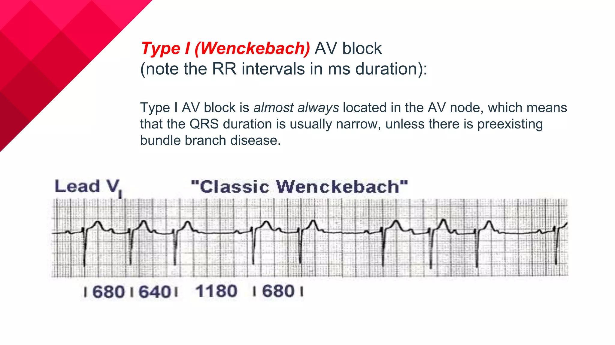 ECG Conduction Abnormalities | PPTX