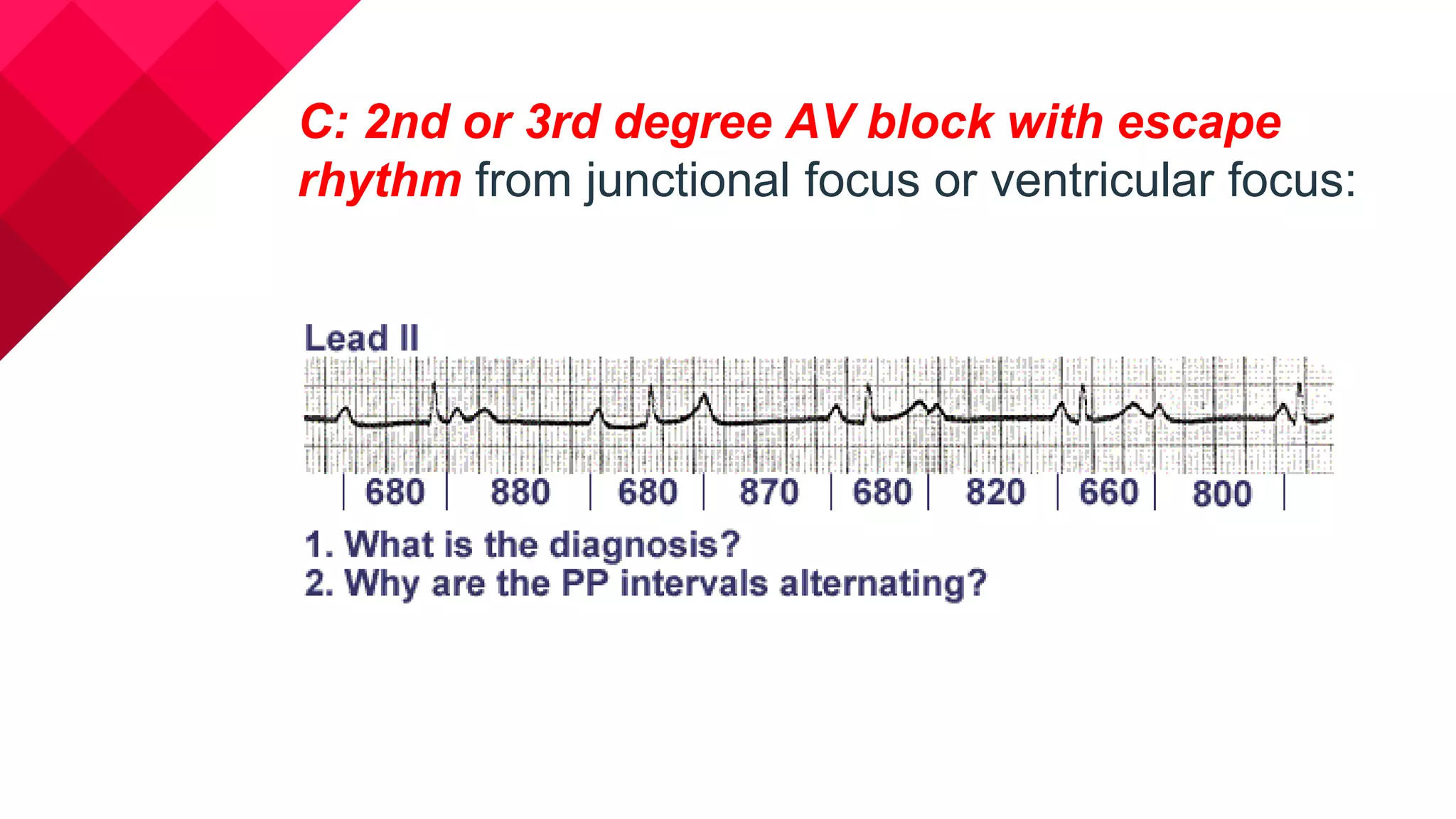 ECG Conduction Abnormalities | PPTX | Heart and Cardiovascular Diseases ...