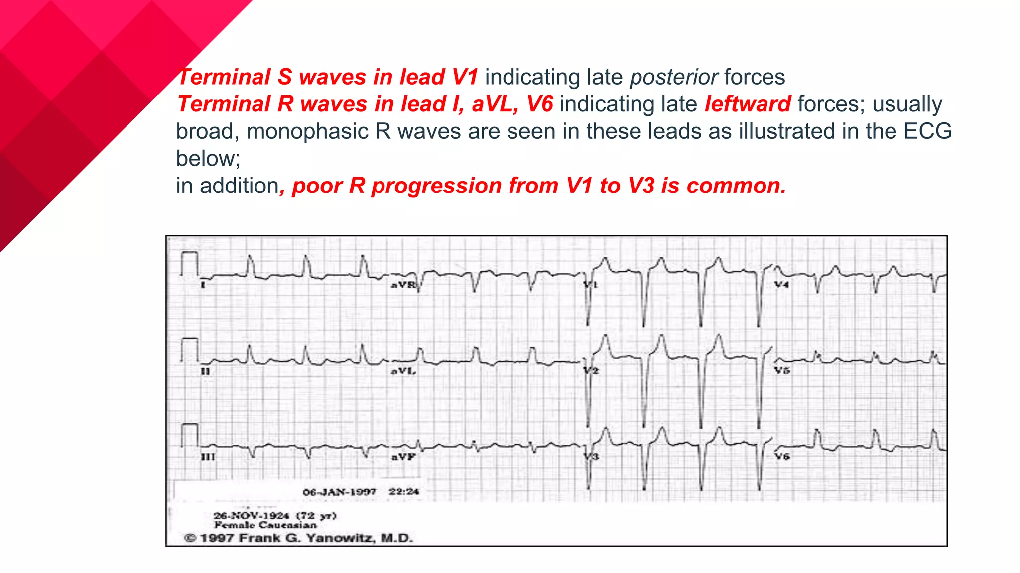ECG Conduction Abnormalities | PPTX