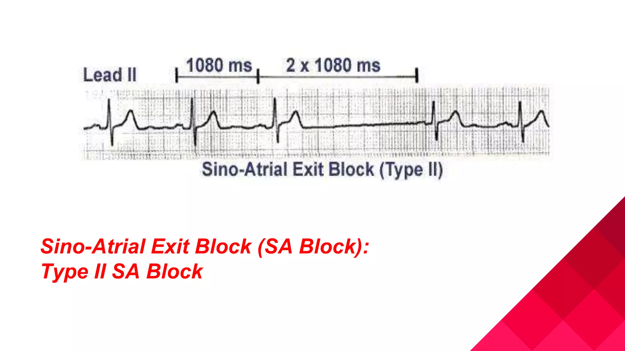 ECG Conduction Abnormalities | PPTX