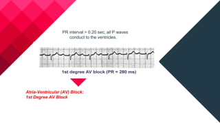 ECG Conduction Abnormalities | PPTX