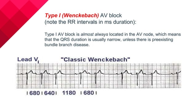 ECG Conduction Abnormalities | PPTX | Heart and Cardiovascular Diseases ...