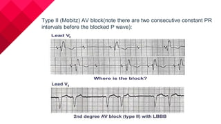 ECG Conduction Abnormalities | PPTX