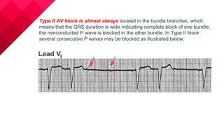 ECG Conduction Abnormalities | PPTX
