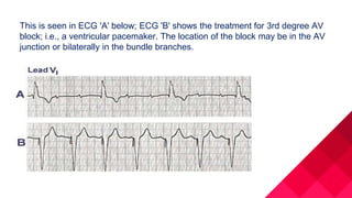 ECG Conduction Abnormalities | PPTX