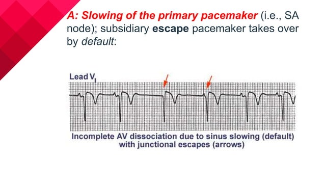 ECG Conduction Abnormalities | PPTX | Heart and Cardiovascular Diseases ...