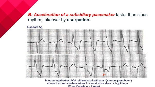 ECG Conduction Abnormalities | PPTX | Heart and Cardiovascular Diseases ...