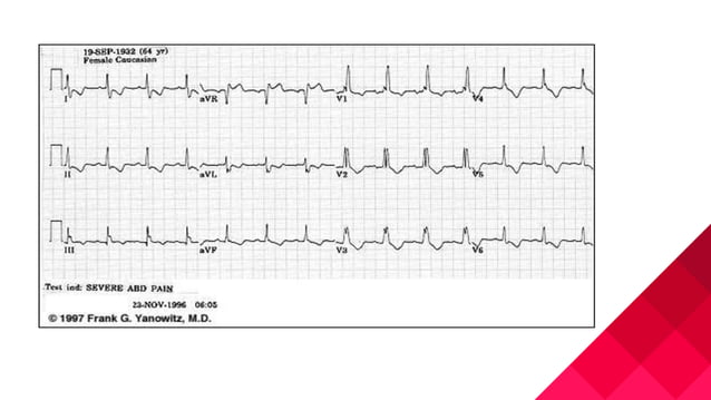 Ecg Conduction Abnormalities Pptx