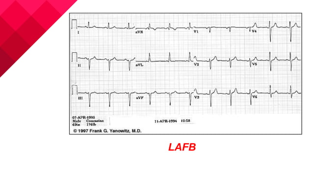 ECG Conduction Abnormalities | PPTX | Heart and Cardiovascular Diseases ...