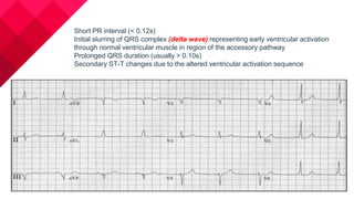 ECG Conduction Abnormalities | PPTX