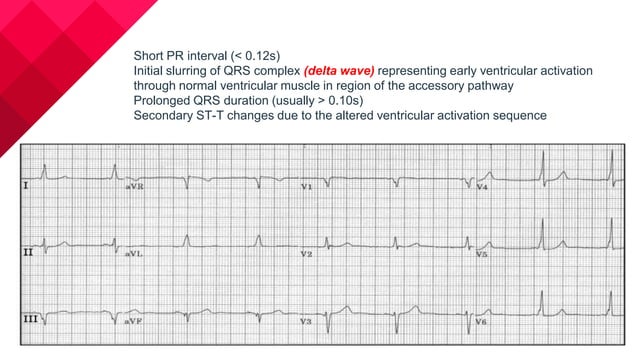Ecg Conduction Abnormalities Pptx Heart And Cardiovascular Diseases Diseases And Conditions