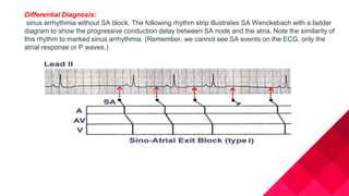 ECG Conduction Abnormalities | PPTX