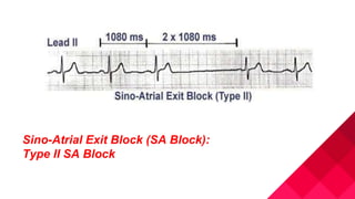 ECG Conduction Abnormalities | PPTX