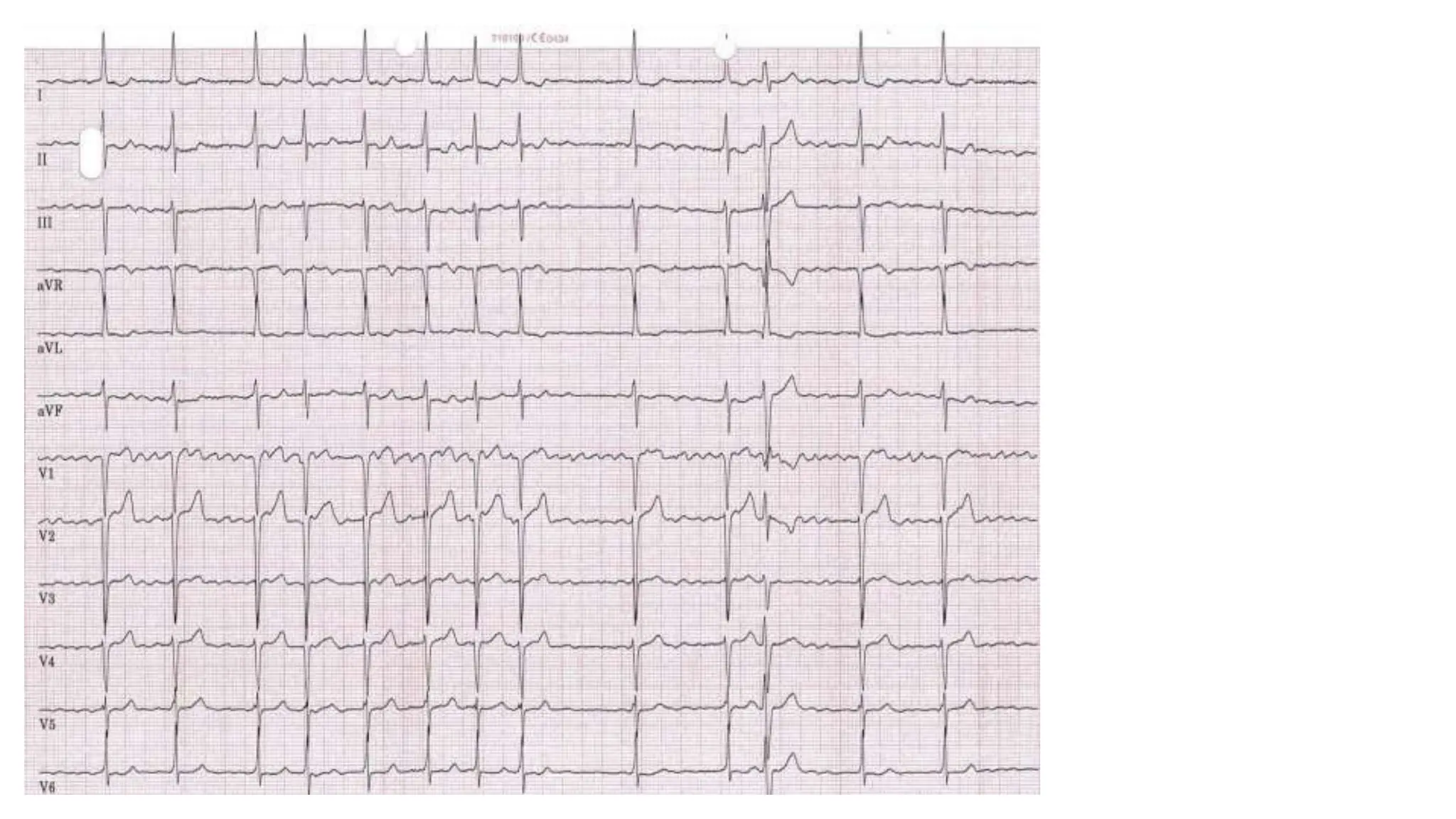 ECG slides for reference - extra copy go | PPT