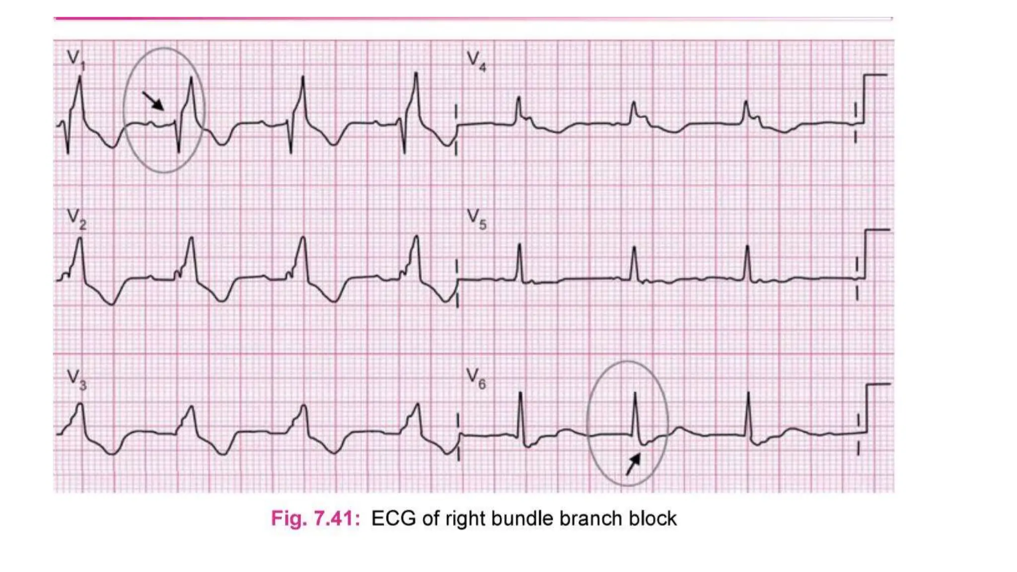 ECG slides for reference - extra copy go | PPTX
