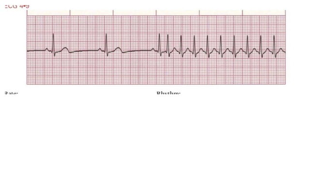 ECG slides for reference - extra copy go | PPT