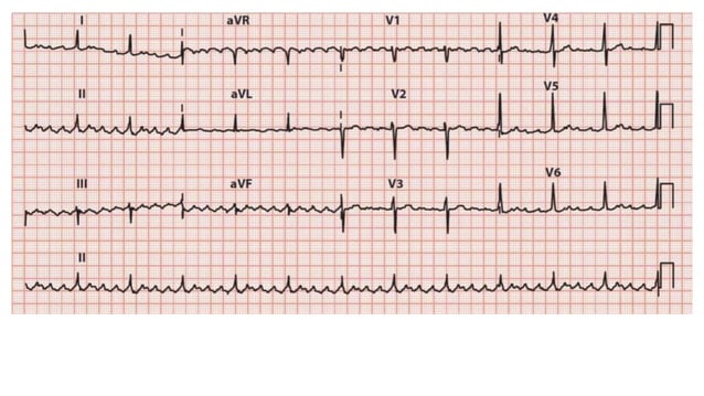 ECG slides for reference - extra copy go | PPT