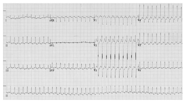 ECG slides for reference - extra copy go | PPTX