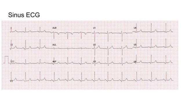 ECG slides for reference - extra copy go | PPT