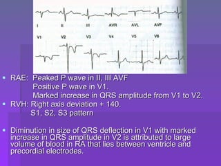 Ecg criteria of chamber enlargement | PPT