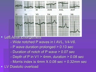 Ecg criteria of chamber enlargement | PPT