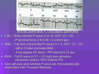 Ecg criteria of chamber enlargement | PPT