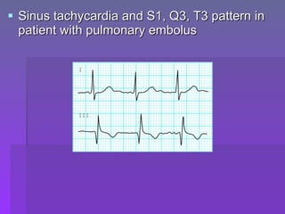 Ecg criteria of chamber enlargement | PPT