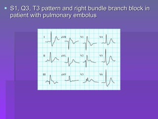 Ecg criteria of chamber enlargement | PPT