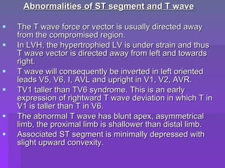 Ecg criteria of chamber enlargement | PPT
