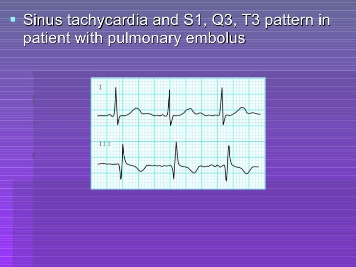 Ecg criteria of chamber enlargement