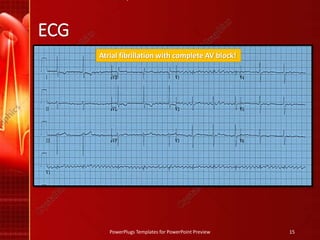ECG D | PPSX