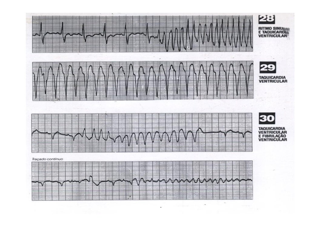 Ecg de arritmias
