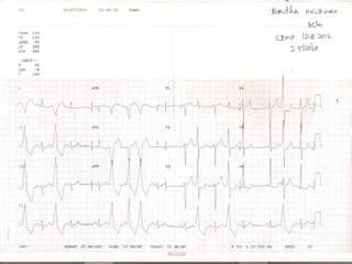 ECG: Interpolated VPCs & Fusion Beat | PPT