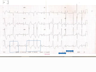 ECG: Interpolated VPCs & Fusion Beat | PPTX