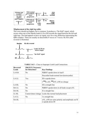Ecg ecg abnormalities | PDF