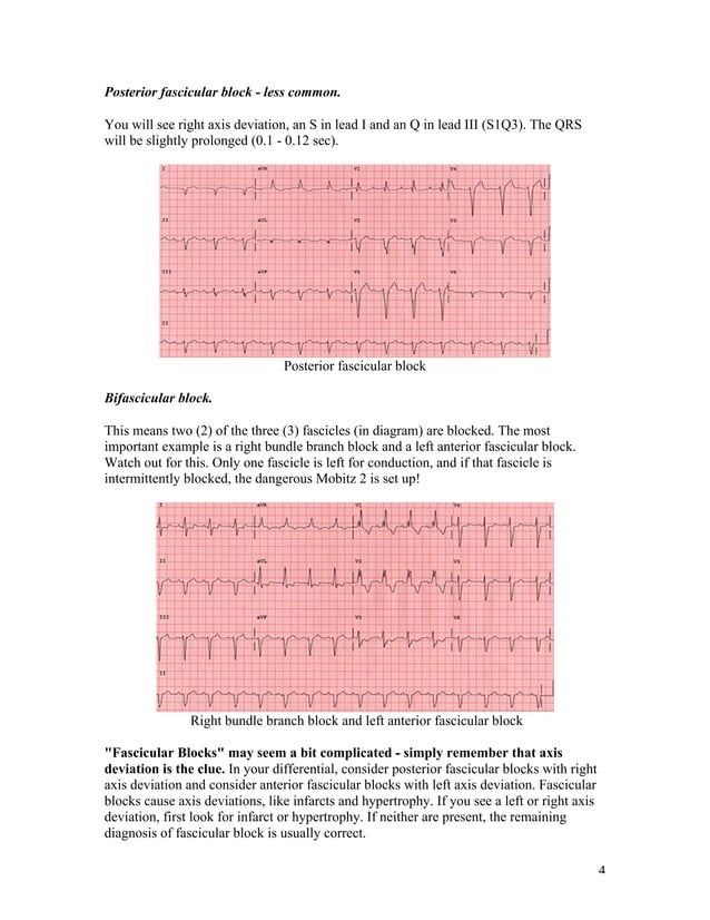 Ecg ecg abnormalities | PDF | Heart and Cardiovascular Diseases ...