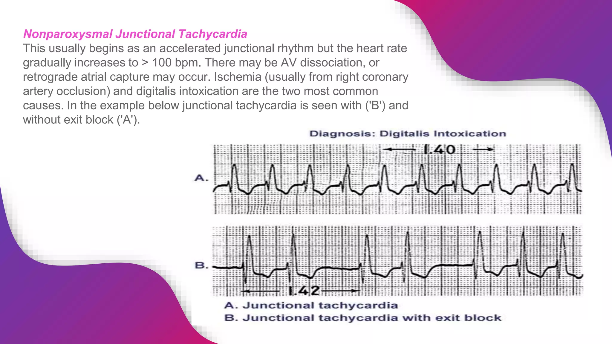 ECG Rhythm Abnormalities | PPT