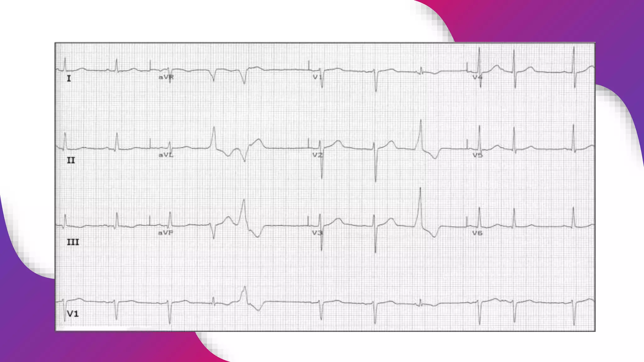 ECG Rhythm Abnormalities | PPTX