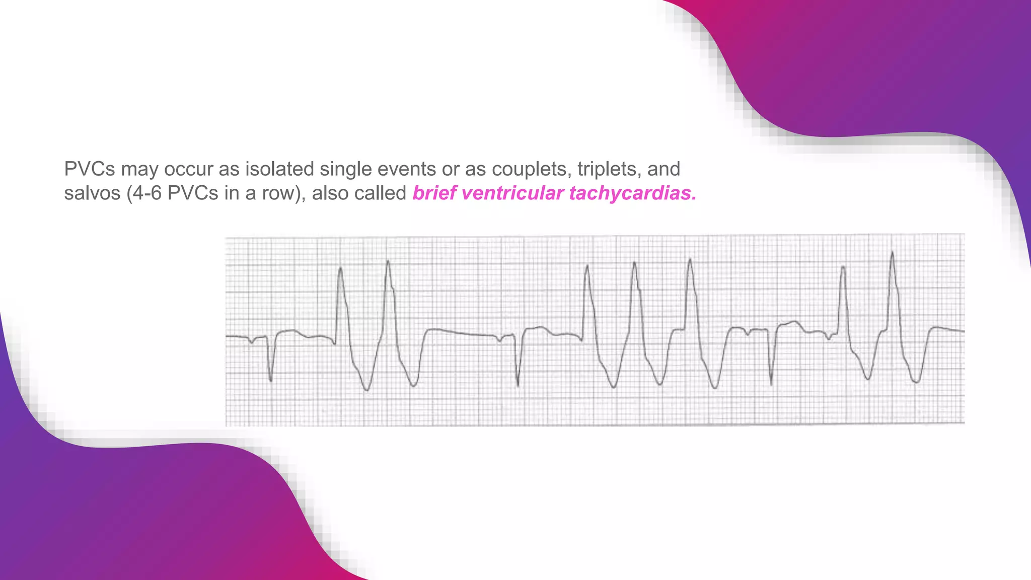 ECG Rhythm Abnormalities | PPTX