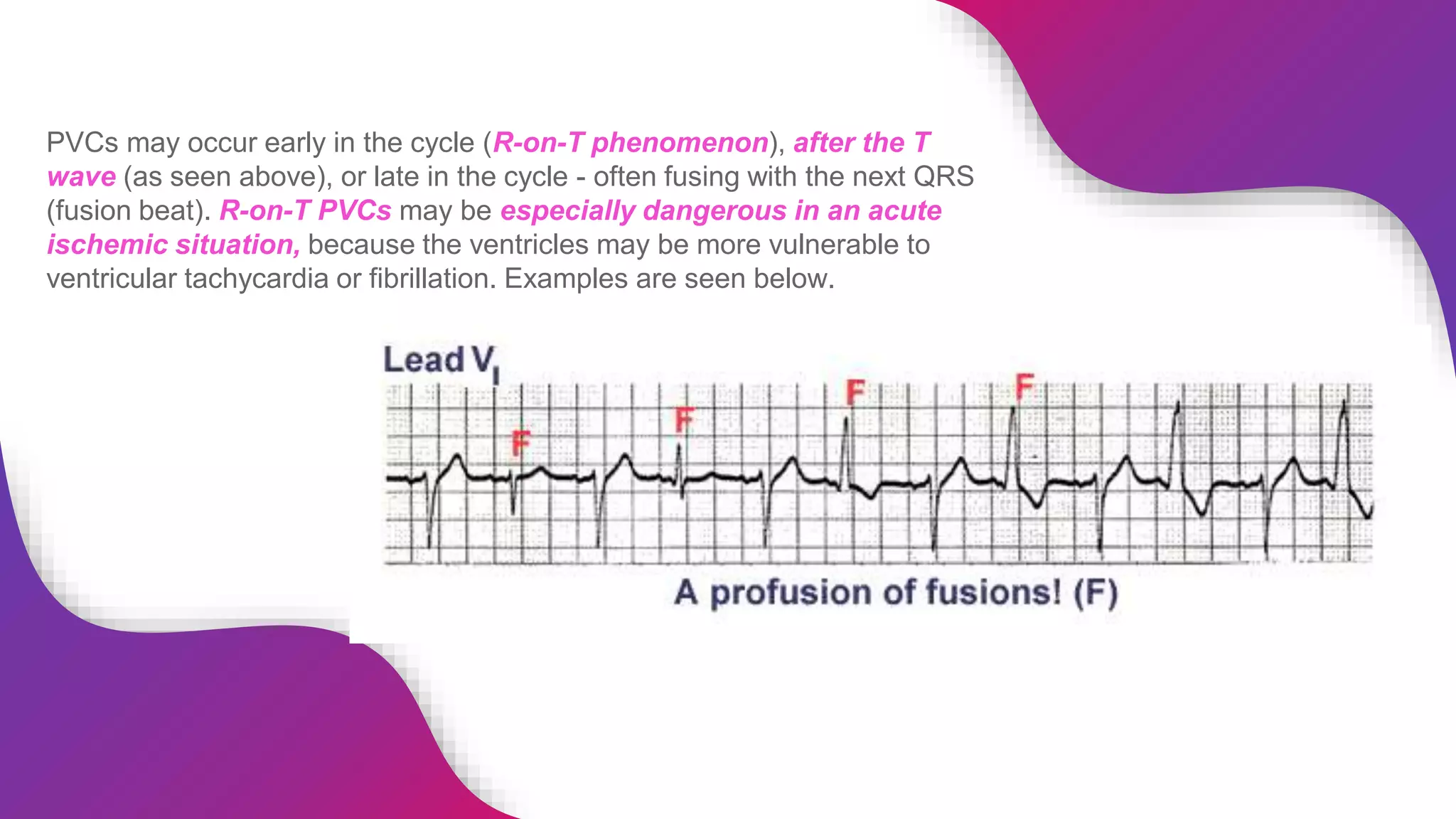 ECG Rhythm Abnormalities | PPTX