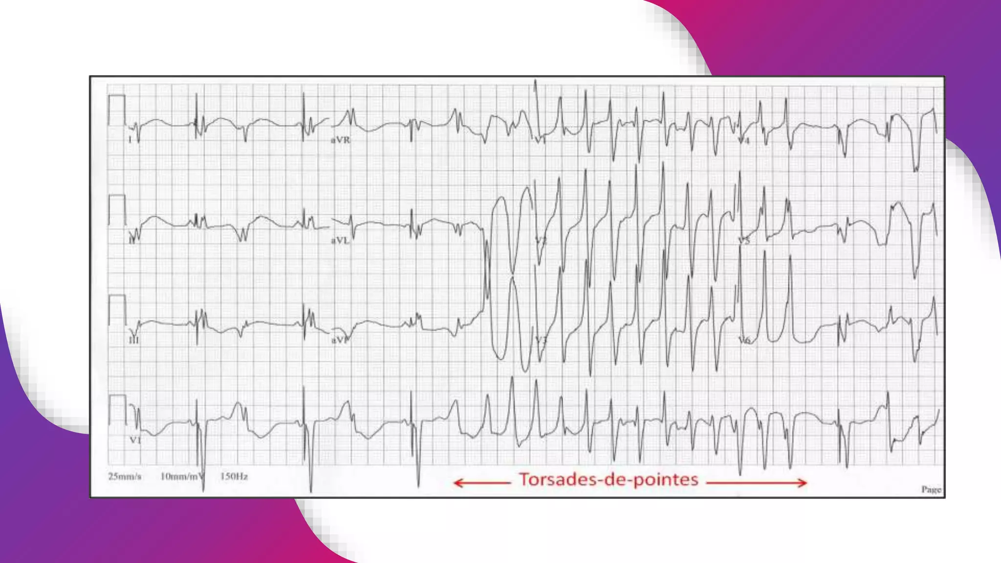 ECG Rhythm Abnormalities | PPTX
