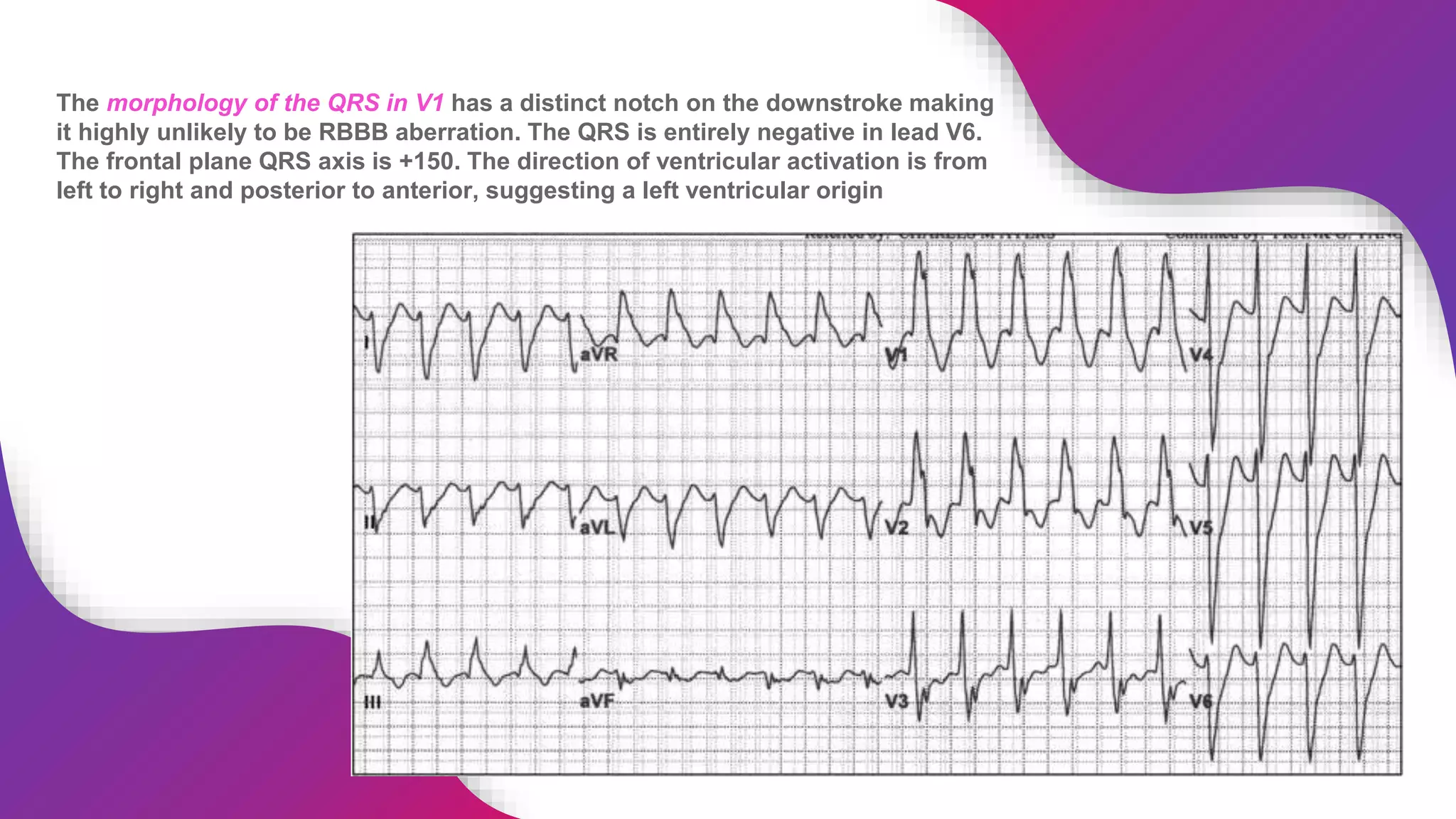 ECG Rhythm Abnormalities | PPT