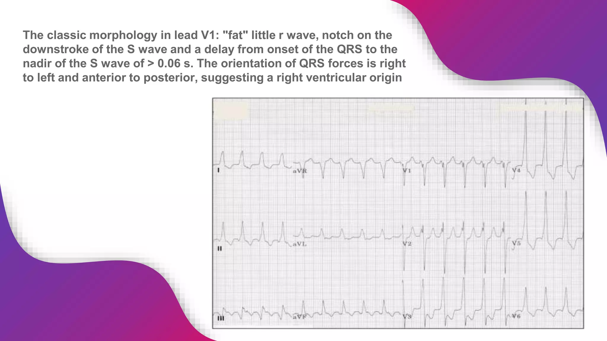ECG Rhythm Abnormalities | PPTX