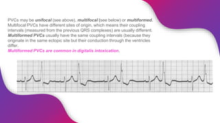 ECG Rhythm Abnormalities | PPTX