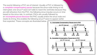 ECG Rhythm Abnormalities | PPTX