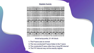 ECG Rhythm Abnormalities | PPT