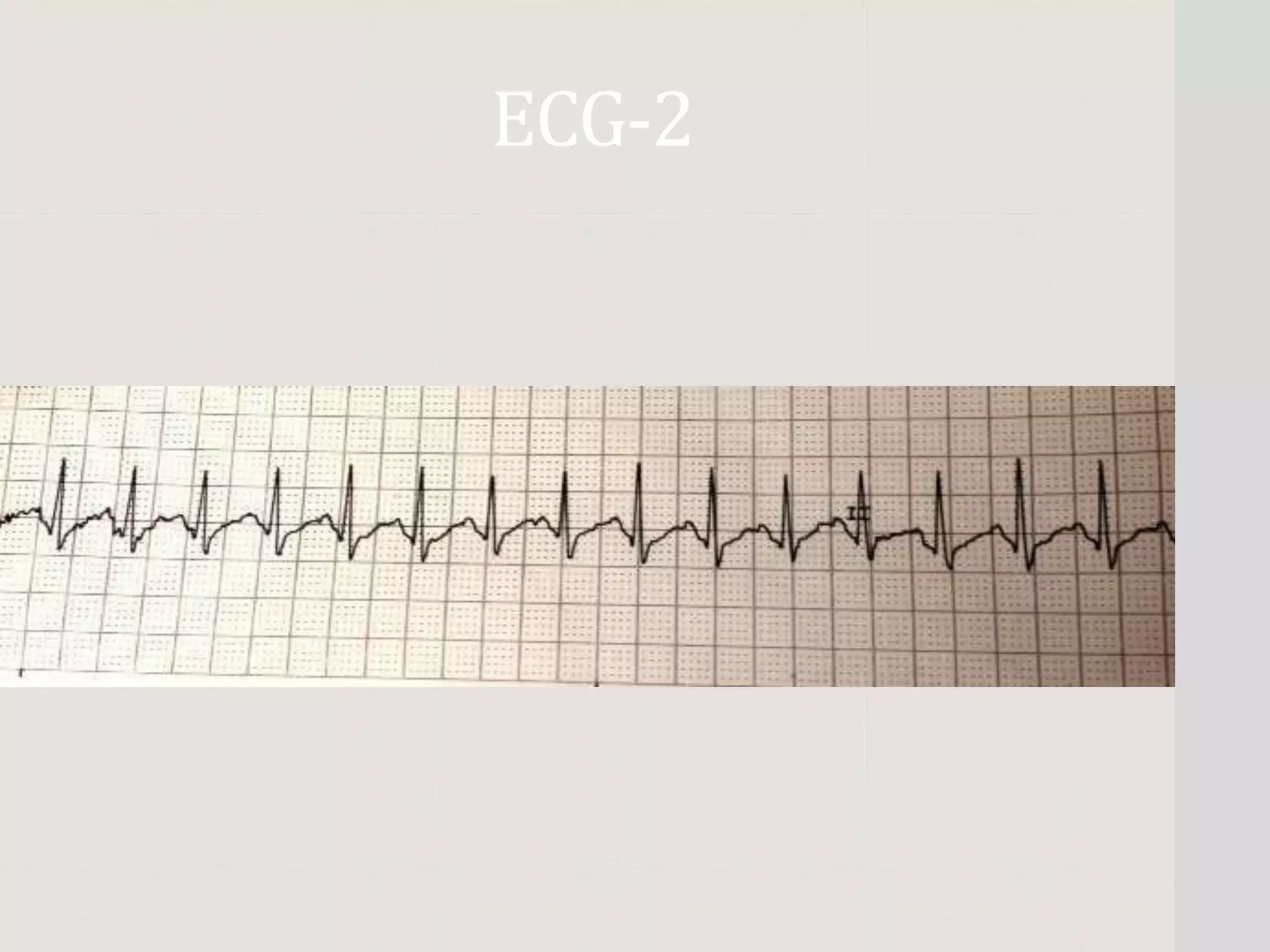 basic ECG SAMPLE WAY | PPTX | Heart and Cardiovascular Diseases | Diseases and Conditions