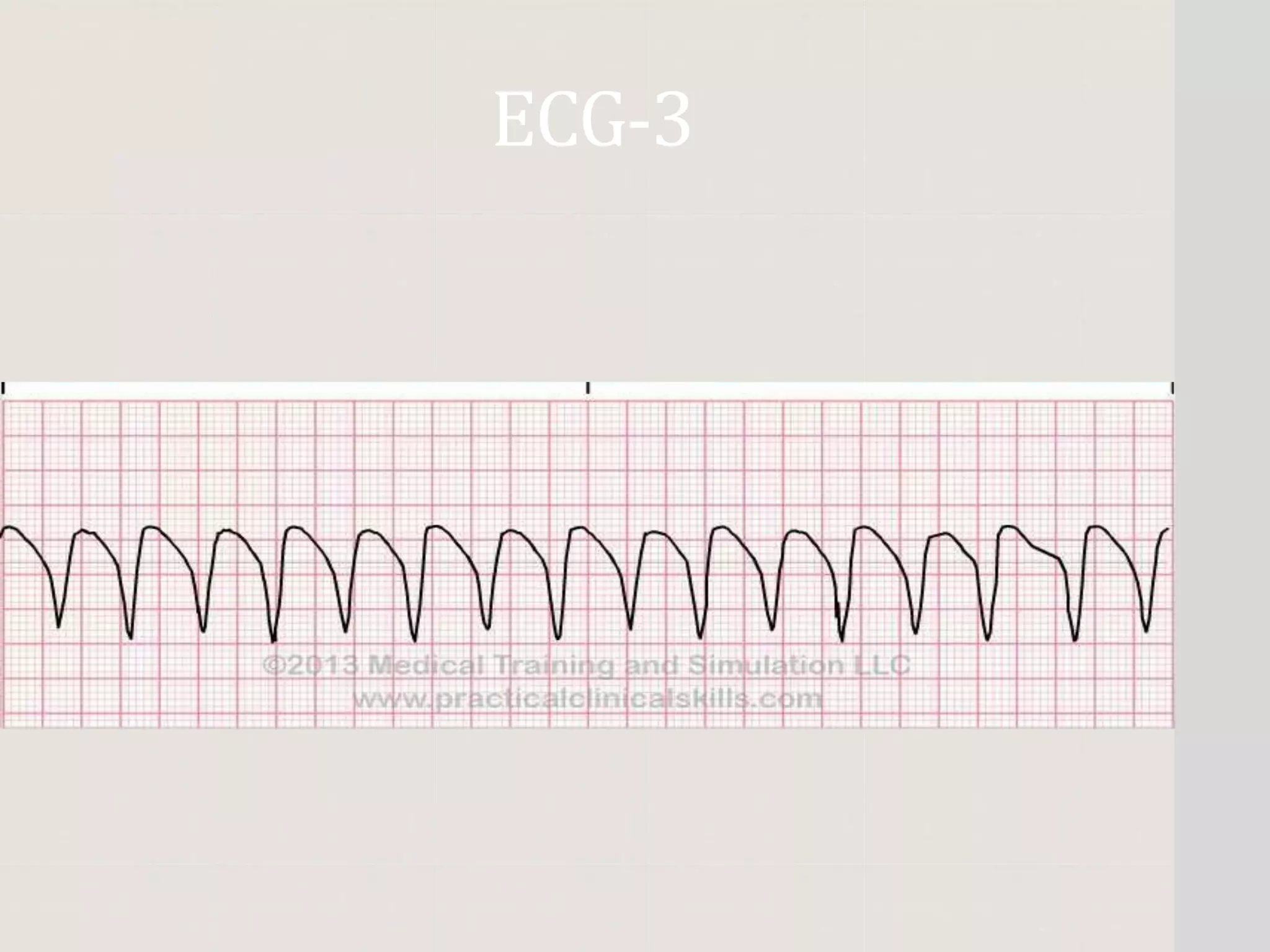 basic ECG SAMPLE WAY | PPTX | Heart and Cardiovascular Diseases | Diseases and Conditions