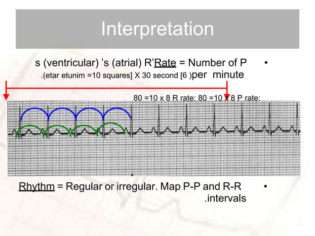 basic ECG SAMPLE WAY | PPTX | Heart and Cardiovascular Diseases ...
