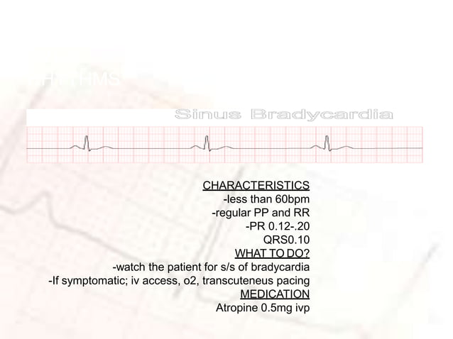 basic ECG SAMPLE WAY | PPTX | Heart and Cardiovascular Diseases ...